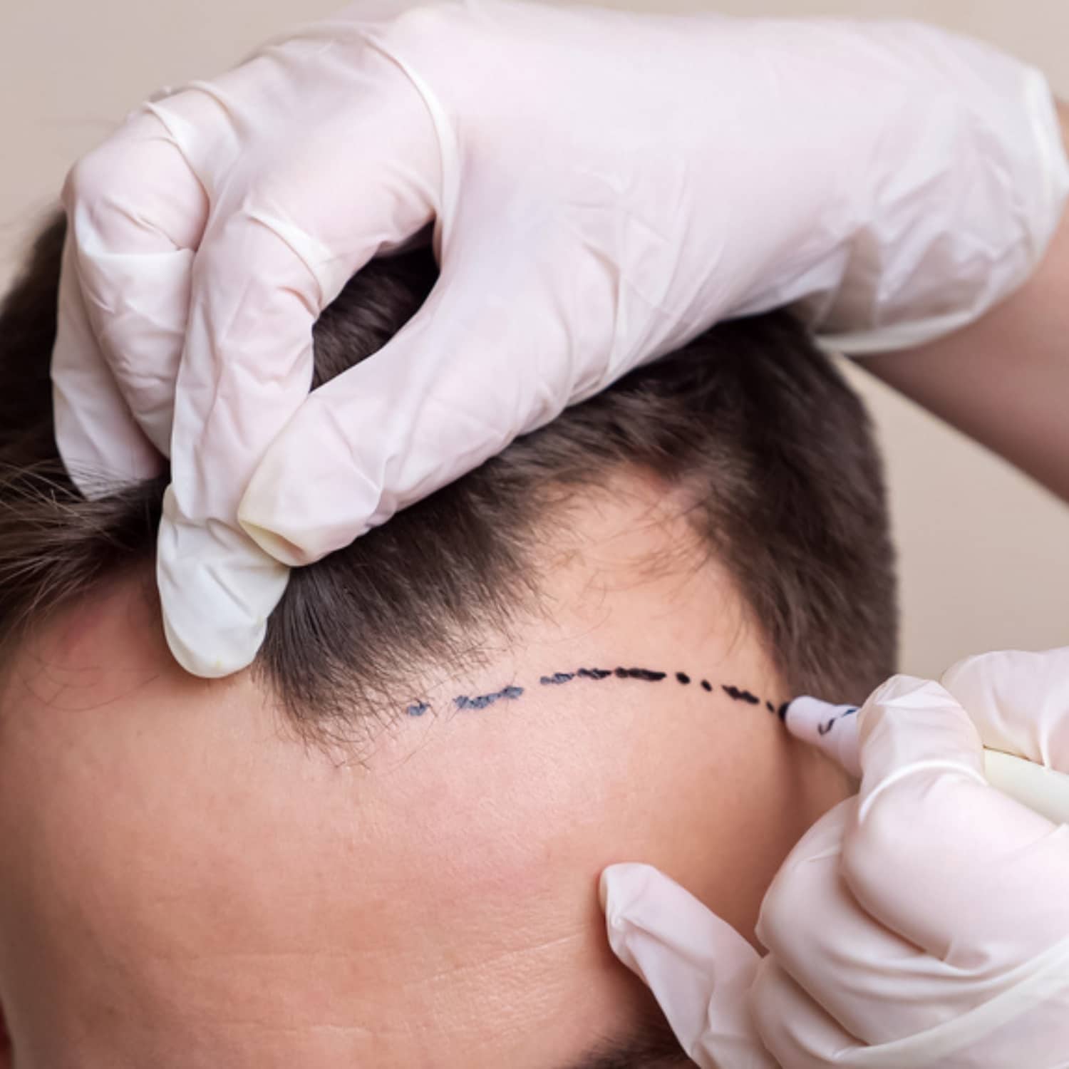 Hair Transplantation Treatments in Istanbul - Get Inquiry